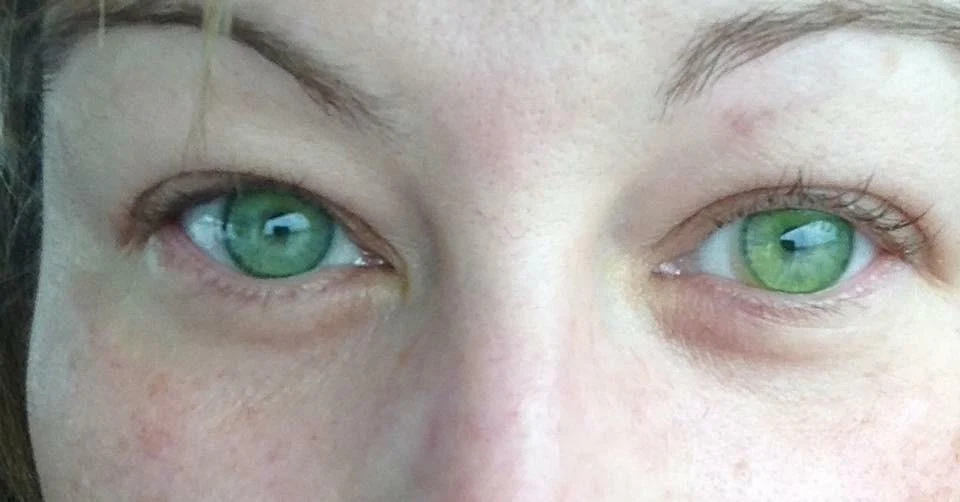 Keratoconus: Ghosting, Halos, and Glare, Oh My! | Keratoconus Group