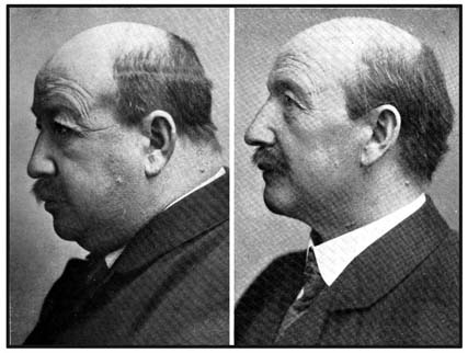 Hypothyroid Face - 180 Degree Health