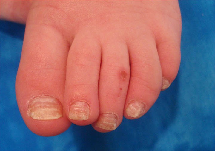 VIRTUAL GRAND ROUNDS IN DERMATOLOGY 2.0: 2 Year Old with Nail Dystrophy