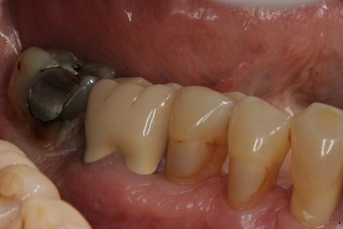 Biological shaping and barrel flute of crown - Bauer Smiles