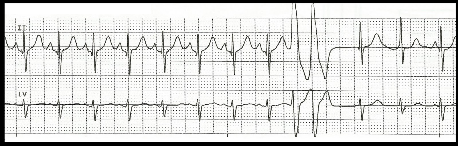 EKG Rhythm Strip Quiz 126