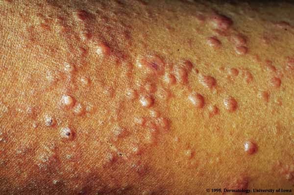 Medical Treatment Pictures-for Better Understanding: Hansen's Disease