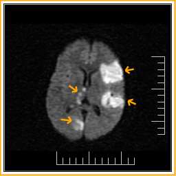 Pediatric Stroke-MRI - Sumer's Radiology Blog