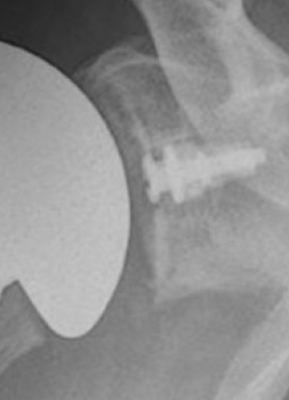 Shoulder Arthritis / Joint Replacement : Total shoulder - glenoid ...