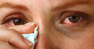 Cara Menyembuhkan Penyakit Mata Merah