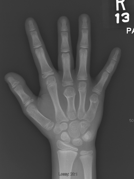 Short Fingers- Brachydactyly | Congenital Hand and Arm Differences ...