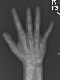 Short Fingers- Brachydactyly | Congenital Hand and Arm Differences ...
