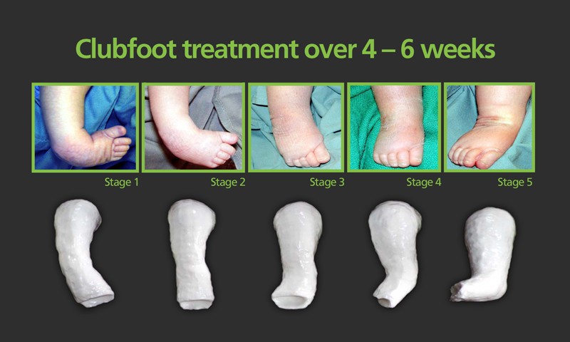 Kistesó megérkezett: Dongaláb kezelése