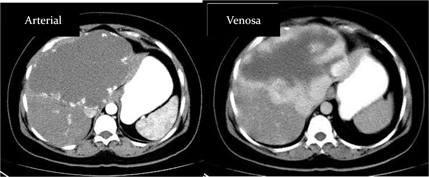 X-RAYview: Afecções Hepáticas - HEMANGIOMA