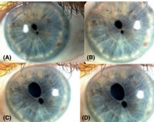 ACERCA DE POLICORIA ( PUPULA DUPLEX O DOBLE PUPILA ) | INFOLENTES