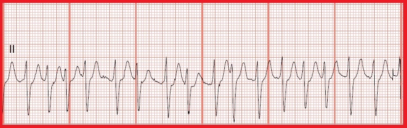 Practice EKG Rhythm Strips 182