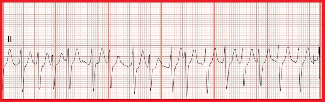 Practice EKG Rhythm Strips 182