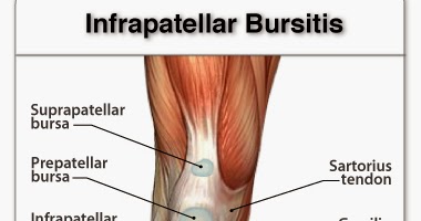 Bursitis Treatments And Education AE6