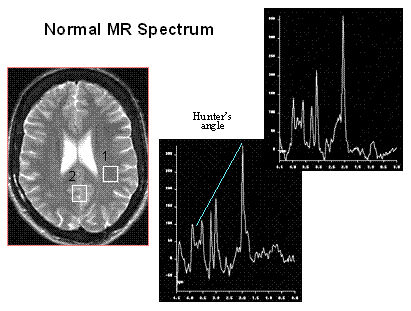 MRI& CT Signs
