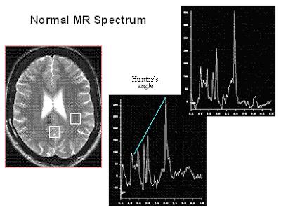 MRI& CT Signs: Brain tumors and MRS