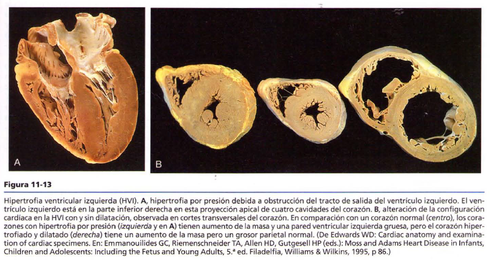 Patología B 2013: CARDIOPATIAS: INSUFICIENCIA CARDIACA CONGESTIVA Y ...