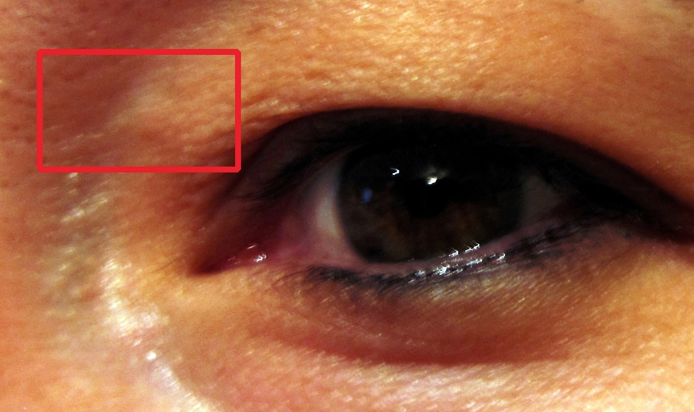 My Journey with Familial Hypercholesterolemia and Heart Disease: The ...