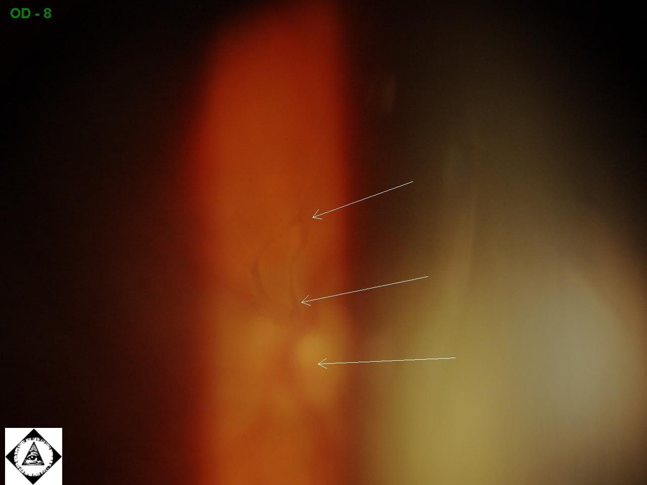 Posterior Vitreous Detachment Weiss Ring
