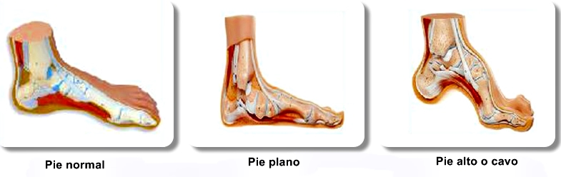 Los problemas del pie plano y de no tratarlo a tiempo