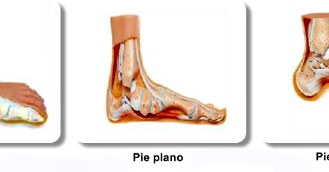 Los problemas del pie plano y de no tratarlo a tiempo