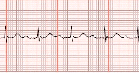 EKG Rhythm Strips 13- Heart Blocks
