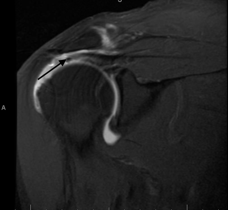 Shoulder and Elbow Surgery: Surgical treatment options for massive ...