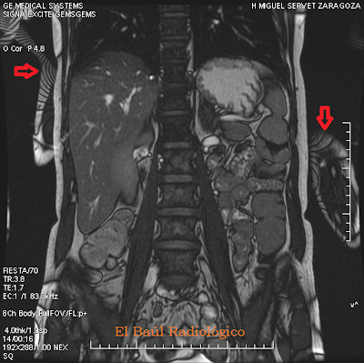 El Baúl Radiológico: BANDAS DE MOIRÉ EN LAS SECUENCIAS DE ECO DE ...