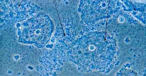 bv: Can BV Clear Up On Its Own – How Long Will It Take for BV To Go ...