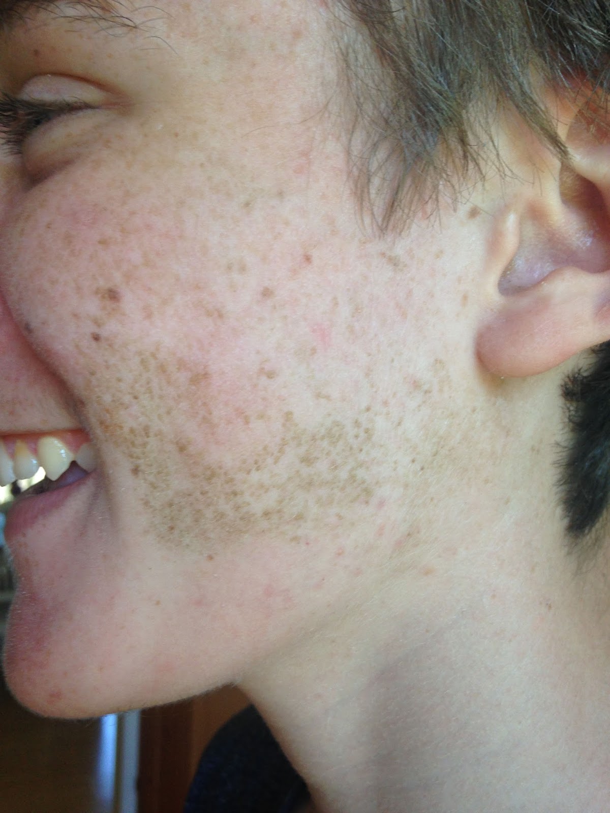 VIRTUAL GRAND ROUNDS IN DERMATOLOGY 2.0: Dermatitis Neglecta