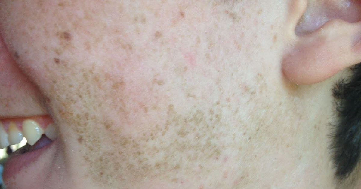 VIRTUAL GRAND ROUNDS IN DERMATOLOGY 2.0: Dermatitis Neglecta
