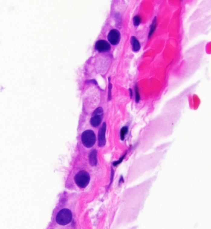 neuropathology blog: Colloid cyst of the third ventricle