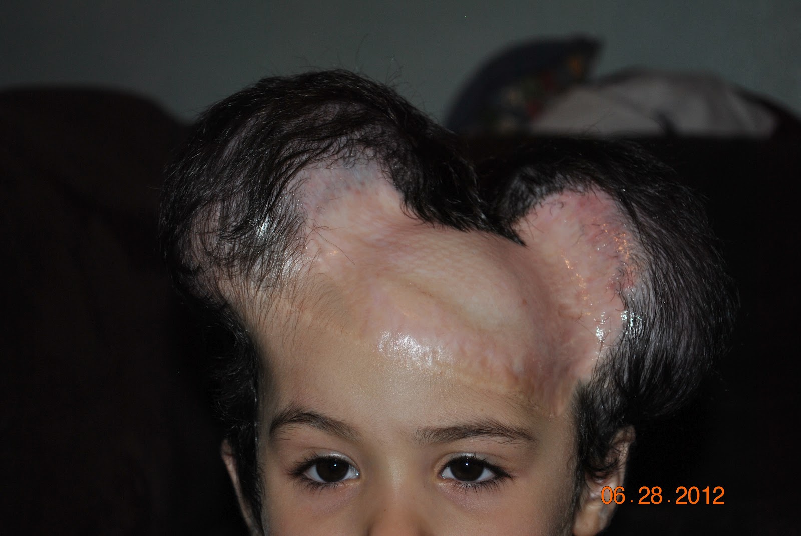 Age 4 Female Scalp Tissue Expanders: WE MADE IT TO 300 CC!!