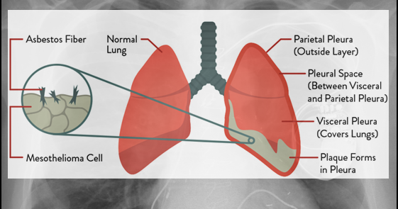 Pleural Mesothelioma - Know Treatment And Diagnosis