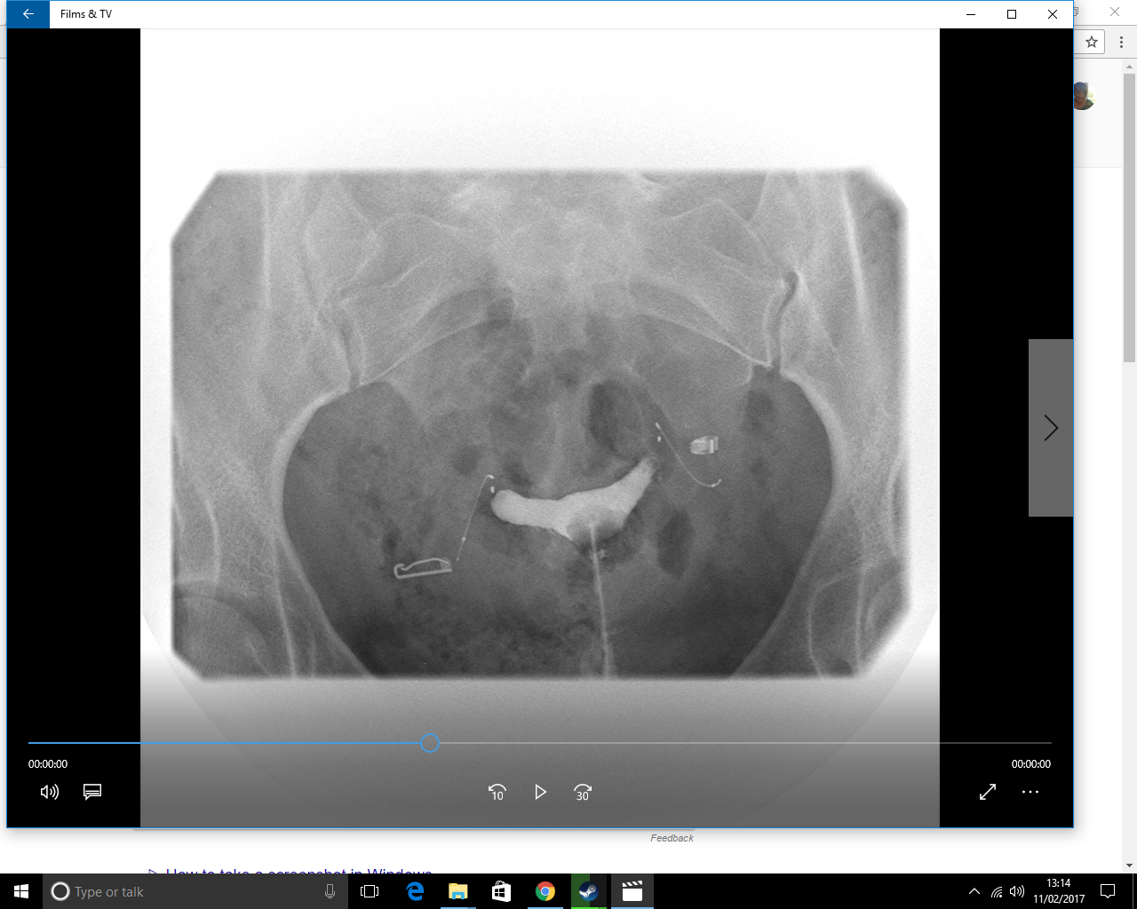 Essure story implanted 2008 Are you really Sure about Essure: Essure ...