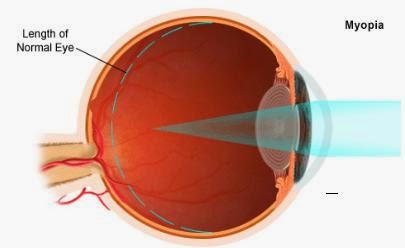Pengertian Miopi atau Rabun Jauh | i Health