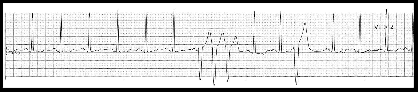 Practice Rhythm Strips 261