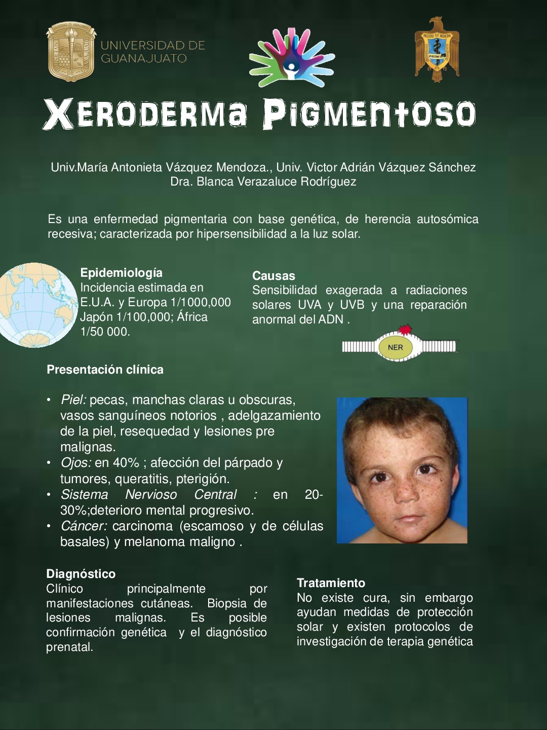 DIVULGACIÓN CIENTÍFICA UG: Xeroderma Pigmentoso