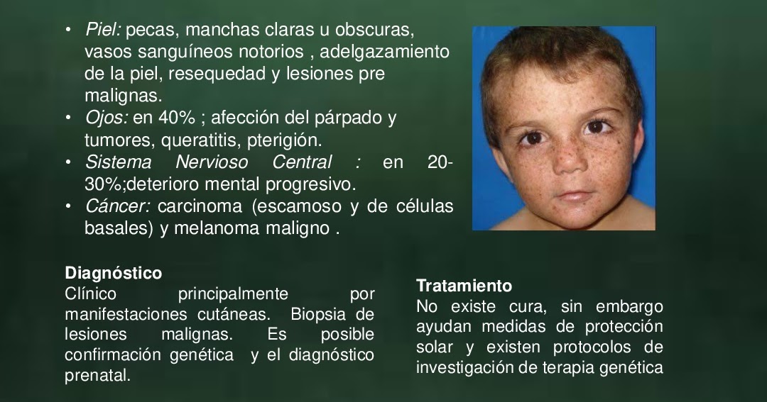 DIVULGACIÓN CIENTÍFICA UG: Xeroderma Pigmentoso