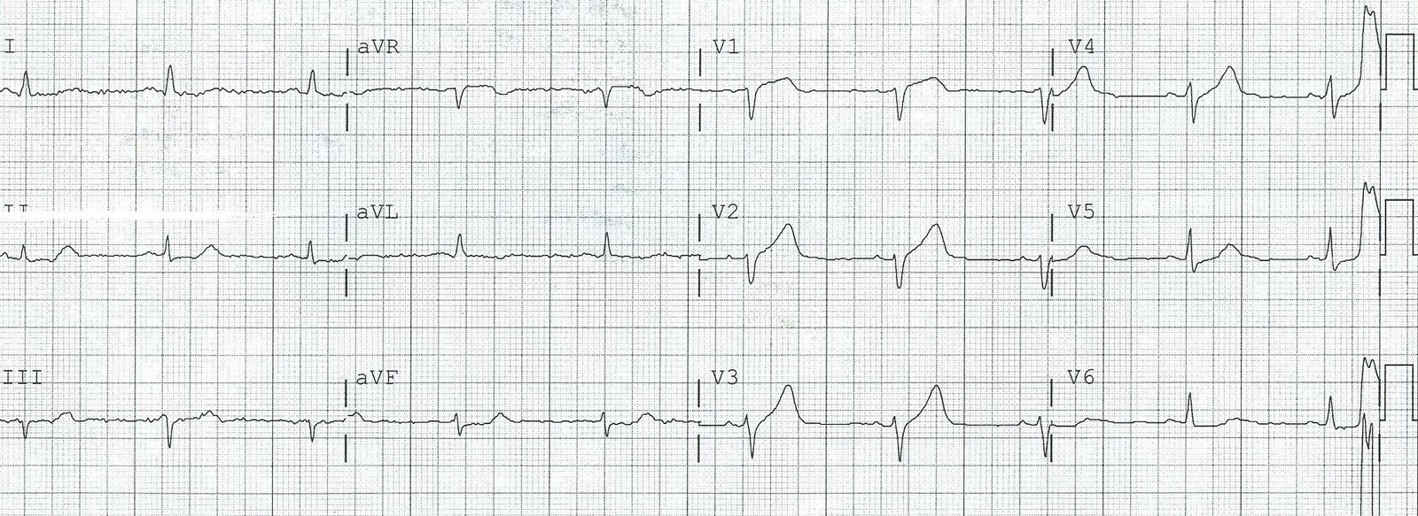 Dr. Smith's ECG Blog: Serial ECGs confirm initial suspicion of anterior ...