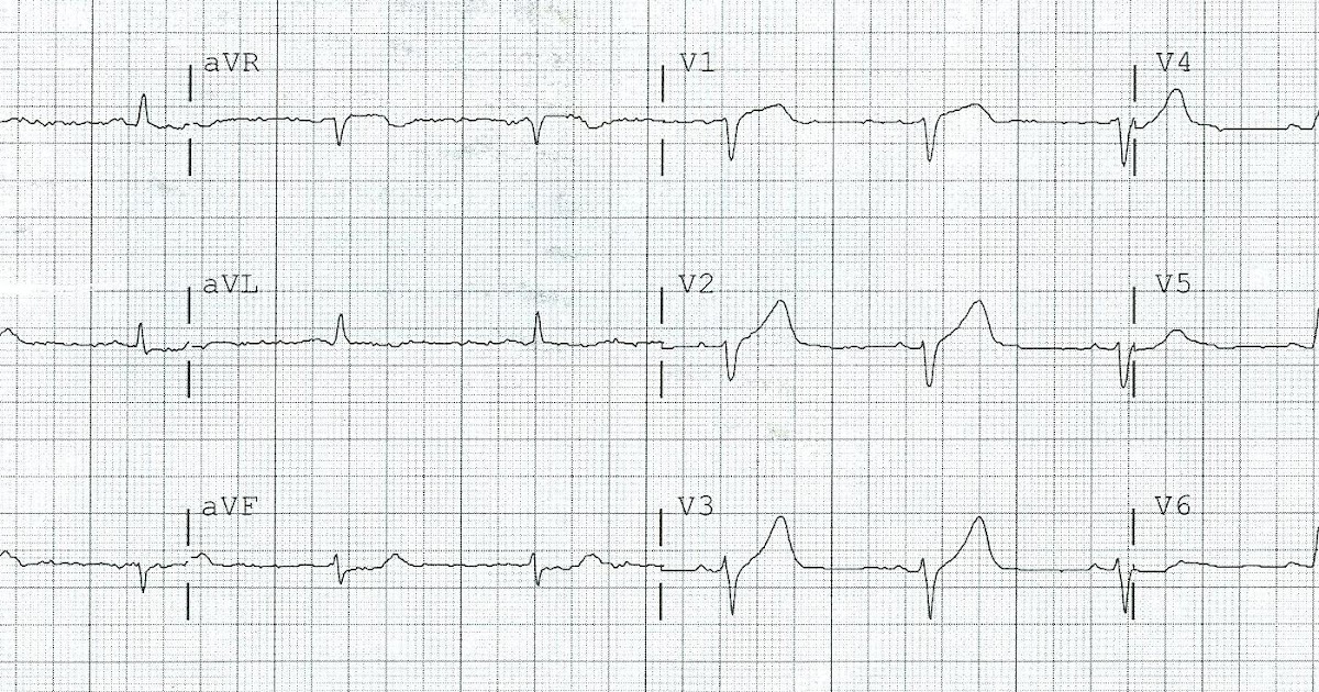 Dr. Smith's ECG Blog: Serial ECGs confirm initial suspicion of anterior ...