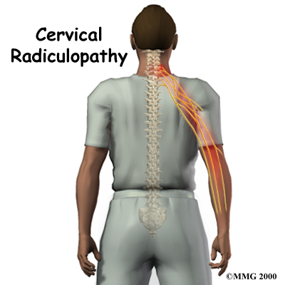 Cluster Tests for Cervical Radiculopathy | Modern Manual Therapy Blog