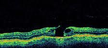 DEGENERACION MACULAR : DMAE HUMEDA CON TRACCION