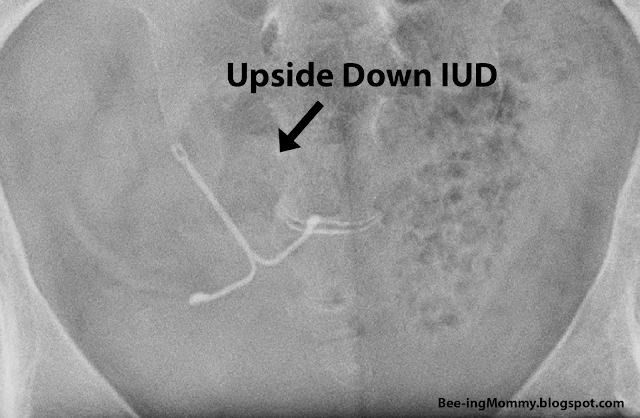 Mirena & Me - My horror story of how my IUD perforated my uterus ...