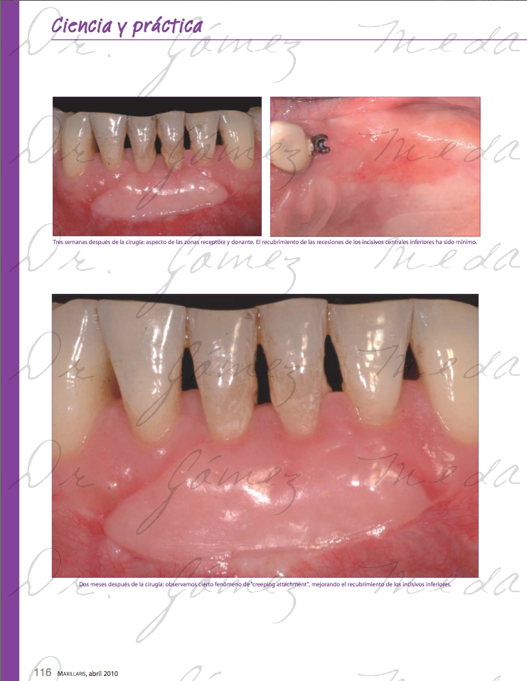 Dr.Meda: Injerto Epitelial Libre: Control de la Estabilidad a Largo ...