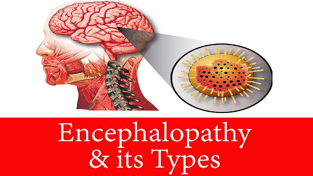What Is Encephalopathy - Teroes