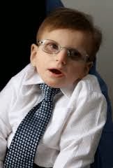 Medical Treatment Pictures-for Better Understanding: Cockayne Syndrome