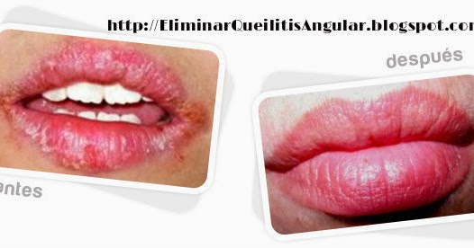 ¿Como Curar Las Boqueras? | Adios Queilitis Angular: VITAMINAS Y ...