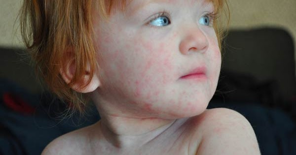 Enfermería Pediátrica: Rubéola