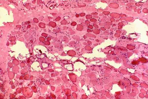 D.M.D.P: El papel de la distrofina