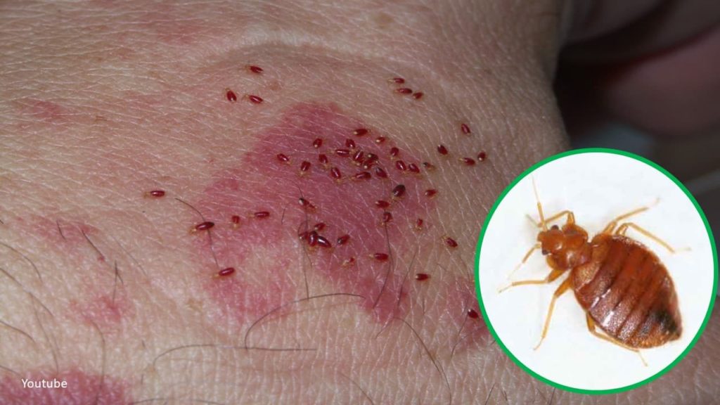 Estimación de la carga actual de la enfermedad de Chagas en México